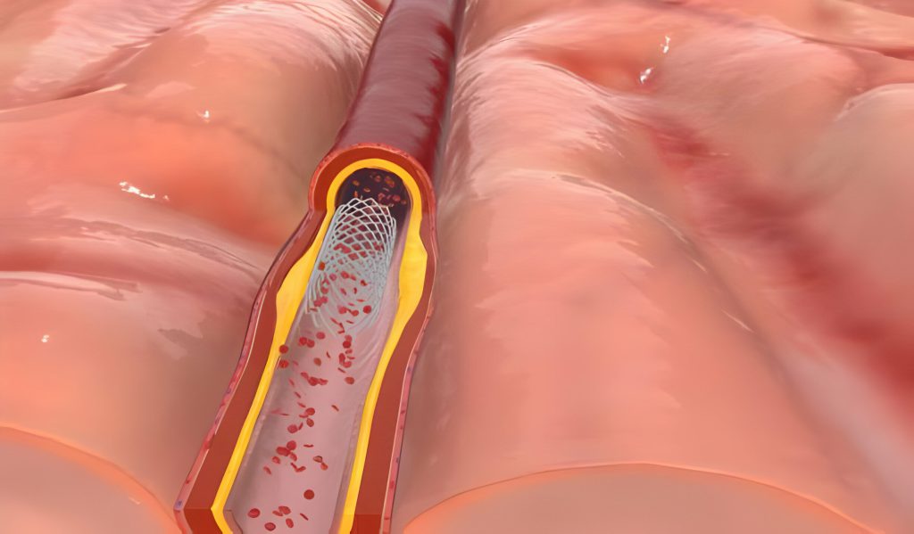 Goiter Surgery: Understanding an Enlarged Thyroid