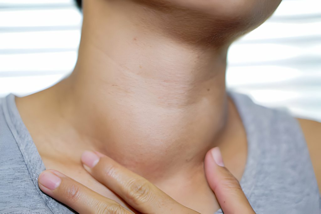 Goiter Surgery: Understanding an Enlarged Thyroid