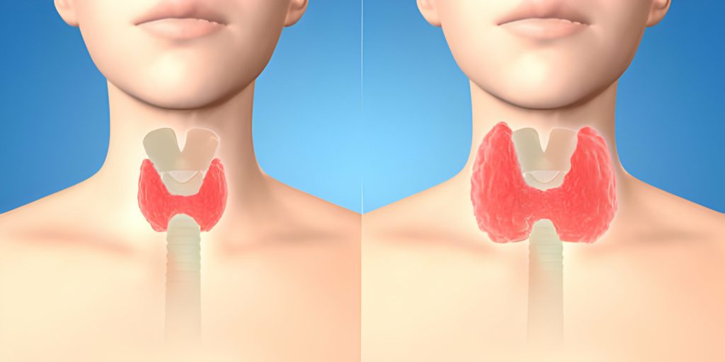 Goiter Surgery: Understanding an Enlarged Thyroid