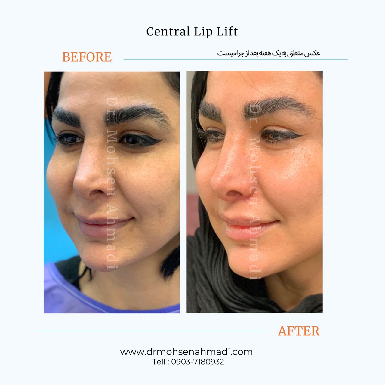 Cholesterol Levels After Gallbladder Removal: Fact vs. Fiction